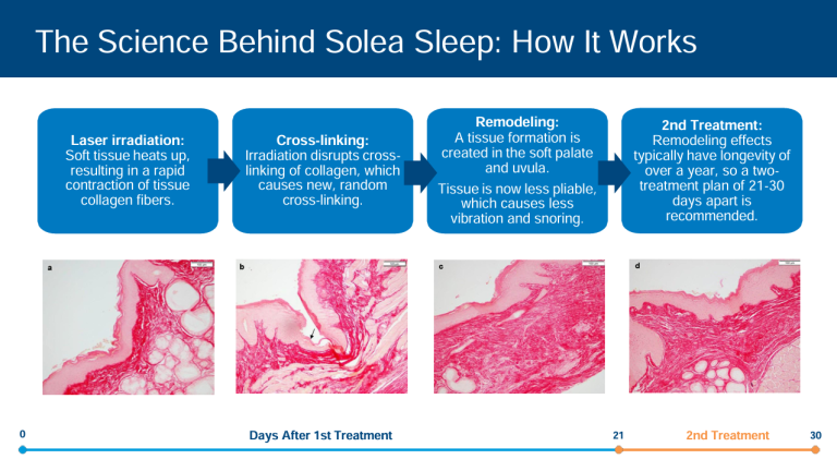 Solea Laser – The Snore Store